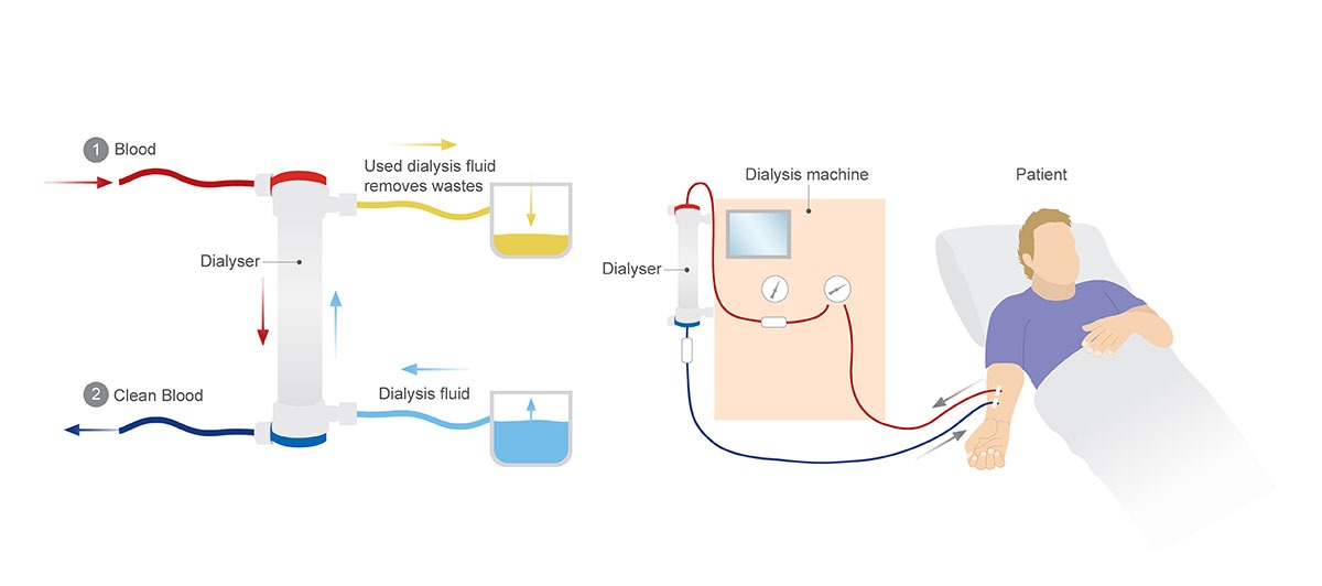Hemodiyaliz – Özel Mersin Diyaliz Merkezi